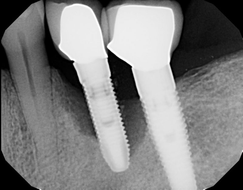 Periodontist, Periodontal Surgery, Lantana, FL – Stuart B. Pechter, D.M.D.