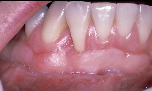 Glossary of Periodontal Terms – Periodontist, Periodontal Surgery ...