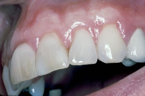 Glossary of Periodontal Terms – Periodontist, Periodontal Surgery ...