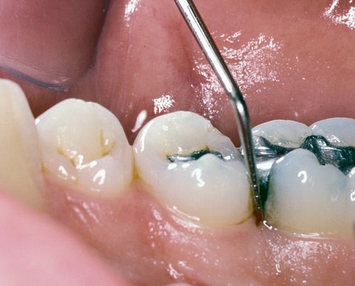 Glossary of Periodontal Terms – Periodontist, Periodontal Surgery ...