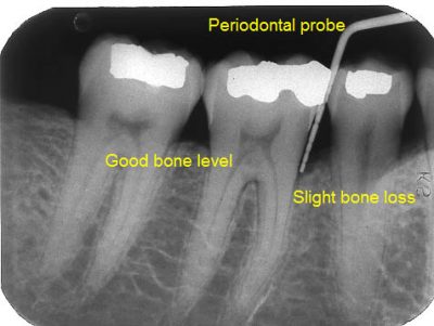 Glossary of Periodontal Terms – Periodontist, Periodontal Surgery ...