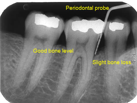 Glossary of Periodontal Terms – Periodontist, Periodontal Surgery ...
