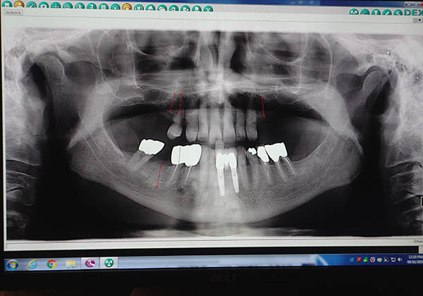 Glossary of Periodontal Terms – Periodontist, Periodontal Surgery ...