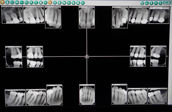 Glossary of Periodontal Terms – Periodontist, Periodontal Surgery ...